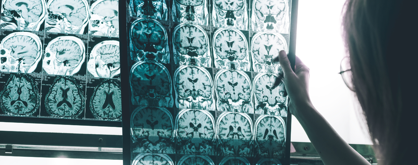 DISQOVER supports the PRISMA consortium in the development of precision medicine for Alzheimer’s